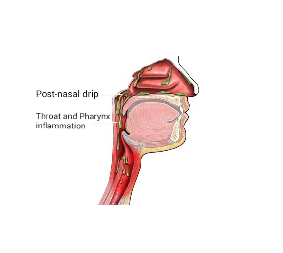 Post Nasal Drip Treatment Post Nasal Drip Cough Dr Ram ENT Hospital