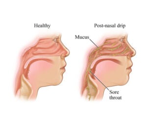 Post Nasal Drip Treatment | Post Nasal Drip Cough | Dr Ram ENT Hospital