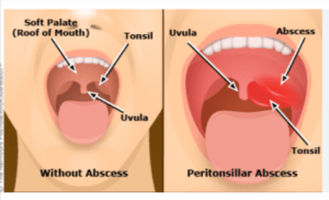 Peritonsillar Abscess Treatment | Throat Abscess Treatment