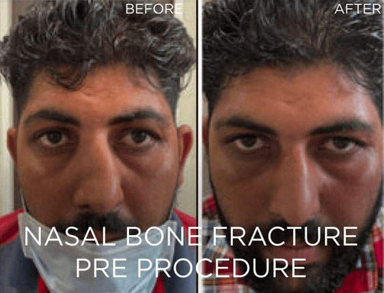 Nasal Bone Fracture Surgery | Nasal Bone Fracture Treatment
