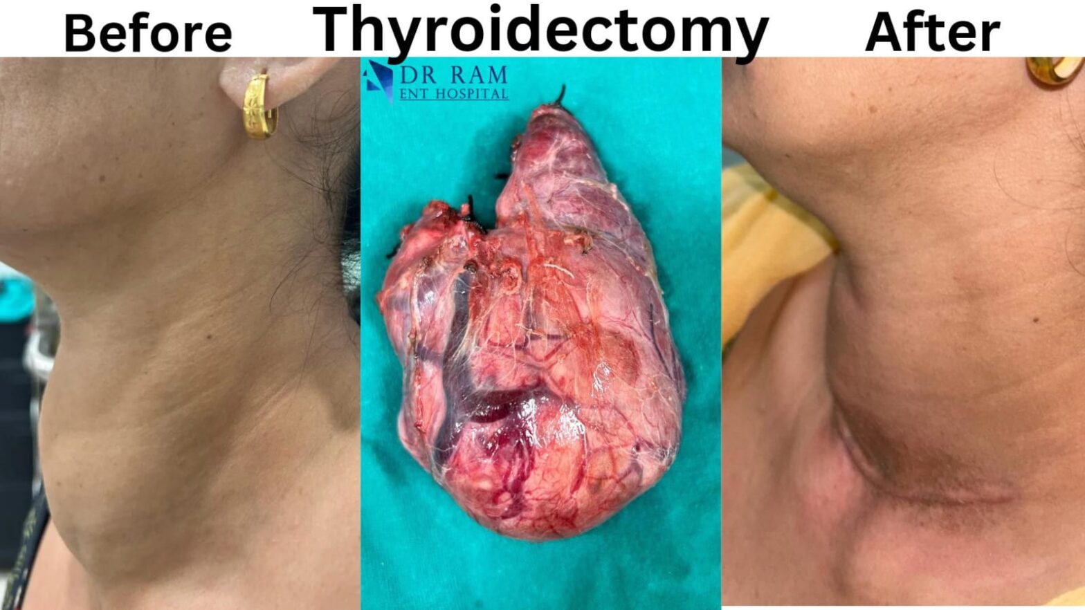 Expert Thyroidectomy Surgery | Thyroid Swelling Treatment at Dr. Ram ...